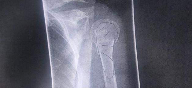 Ein Armbruch zerstörte mein Vertrauen ins Gesundheitssystem